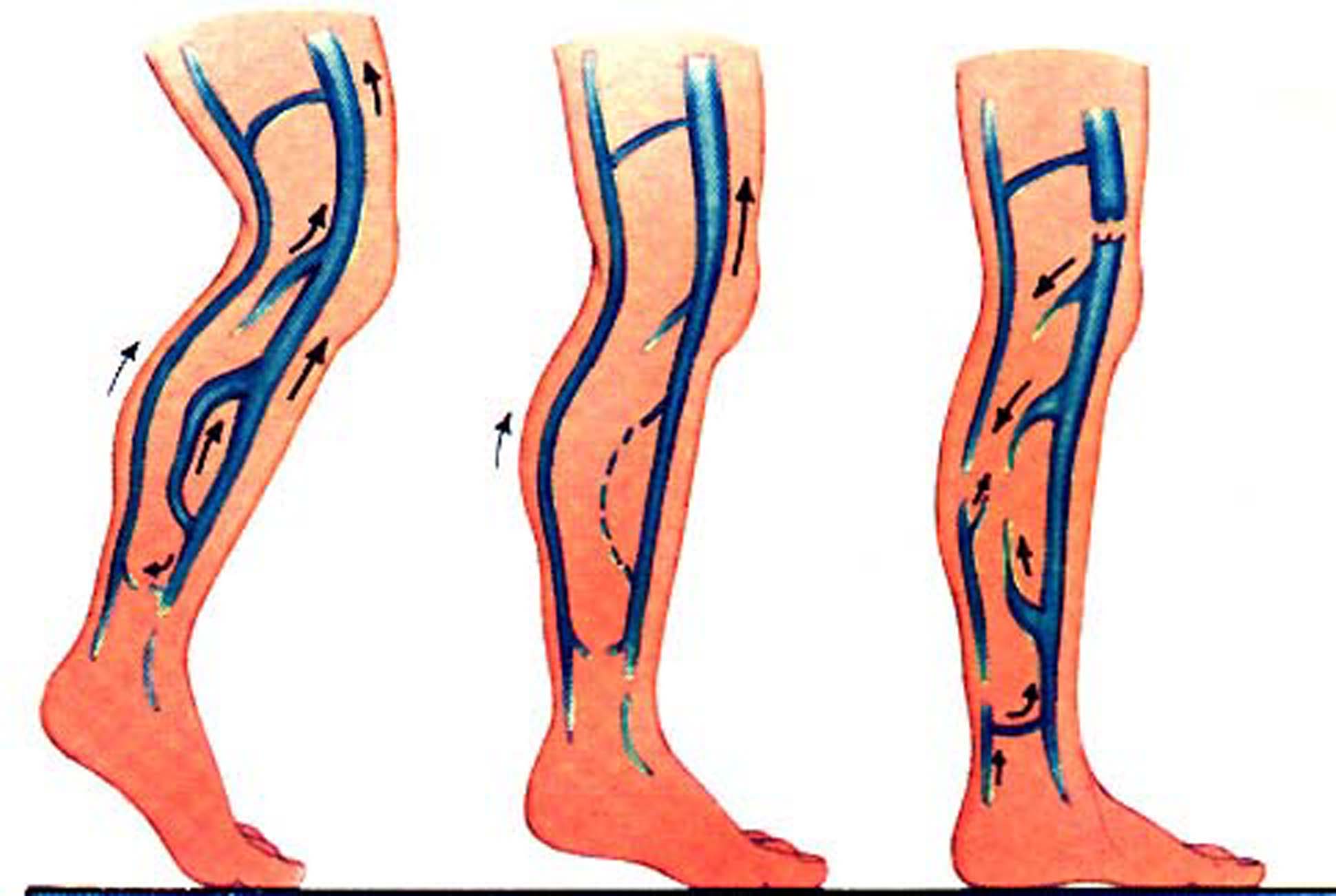 Vene Varicose e insufficienza venosa. Prevenzioni e cura.